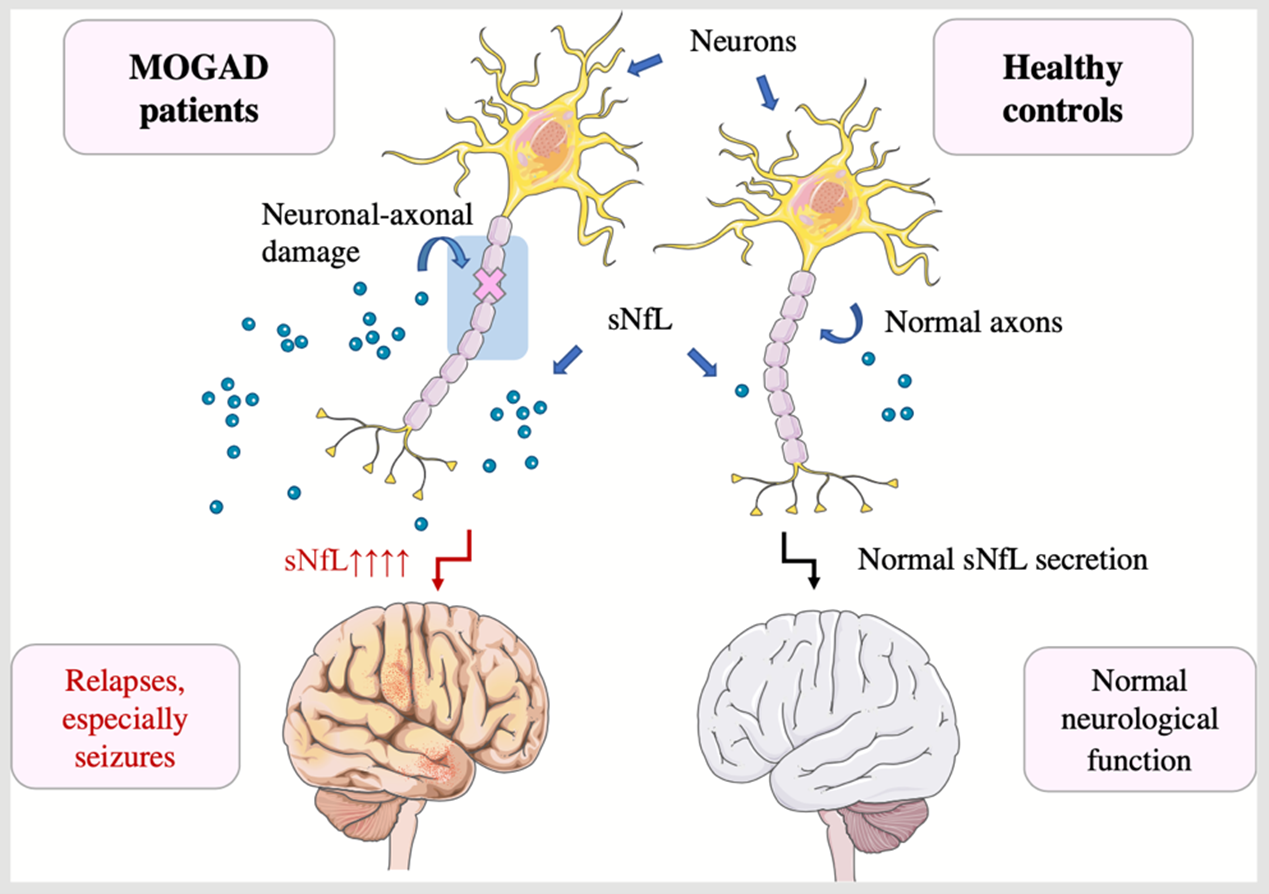 Neurofilament Light Chain (NfL): A Pivotal Biomarker for Neurological ...