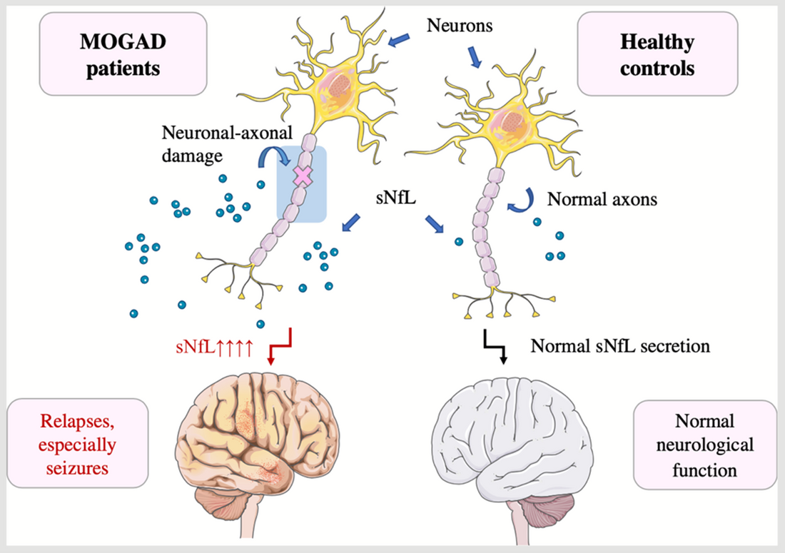 Neurofilament Light Chain (NfL): A Pivotal Biomarker for Neurological ...