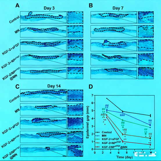 How Do Microneedle Patches Promote Burn Wound Repair through Sequentia ...