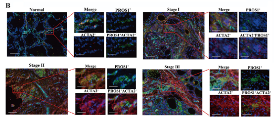 Deciphering the Key Axis of PTMC Progression via Single-Cell and Spati ...